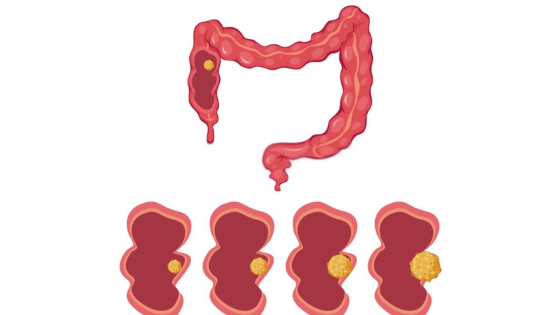 Colon Cancer: Facts to Know - The Health Pages | Online Health Care ...