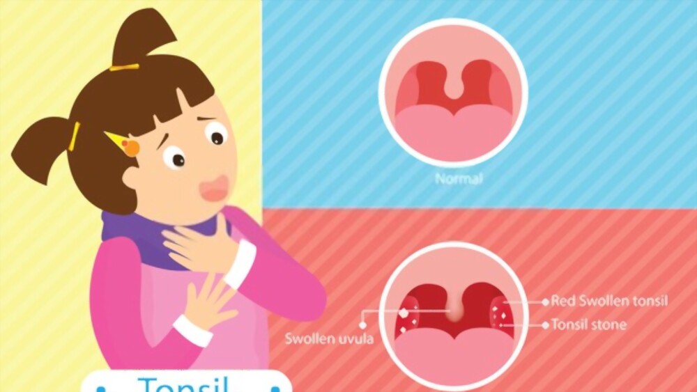 Your Child's Tonsils: In or Out