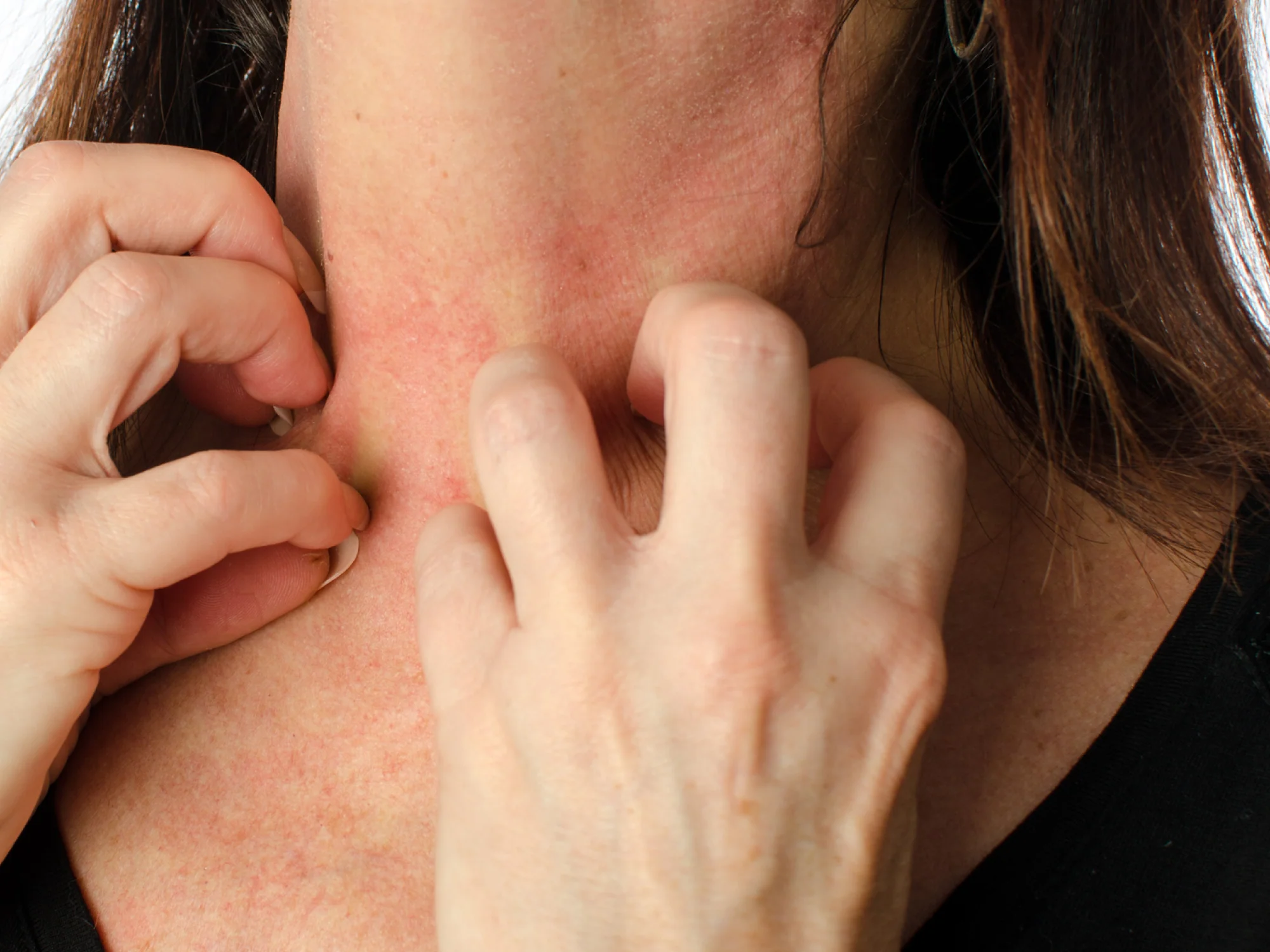 Does Diabetes Cause Skin Rashes? Understanding the Link!