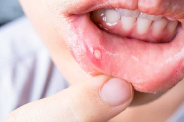 Does Diabetes Cause Mouth Sores? Understanding the Link!