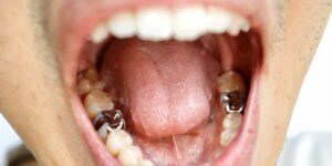 Does Diabetes Cause Tooth Decay? Diabetes and Oral Health!