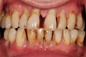 Does Diabetes Cause Tooth Decay? Diabetes and Oral Health!